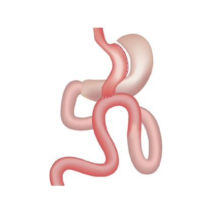 Bariatric (Weight Loss) Surgery: The omega loop gastric bypass (mini ...